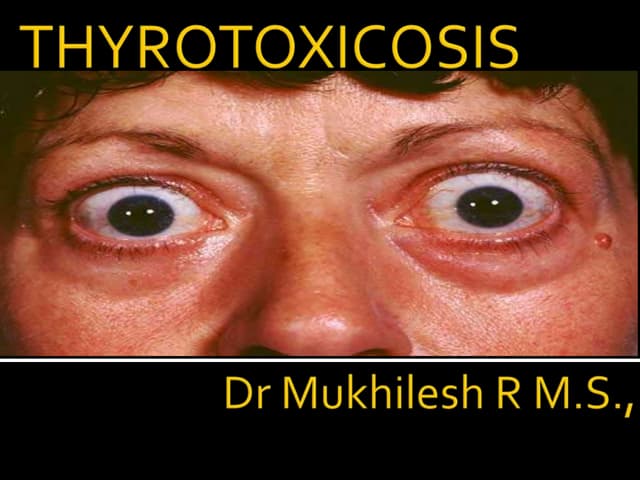 Hyperthyroidism | PPTX