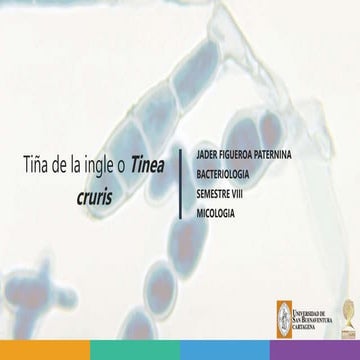 Tiña de la ingle o Tinea cruris.pptx