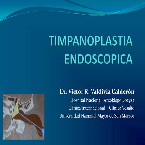 Timpanoplastia endoscopica | PPT