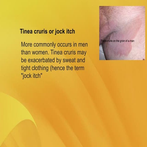 tinea cruris.pdf
