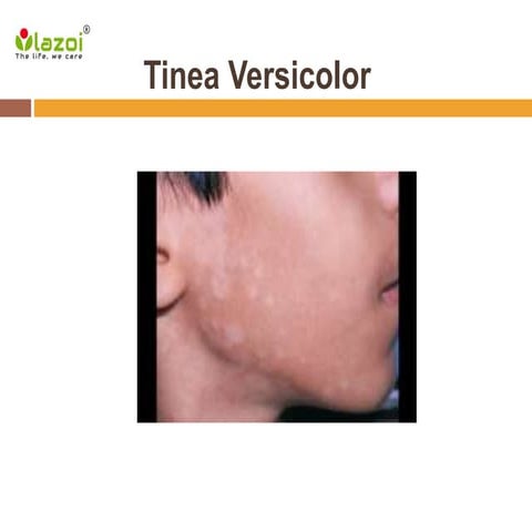 Slit skin smears | PPTX