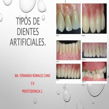 Tipos de dientes artificiales | PPTX