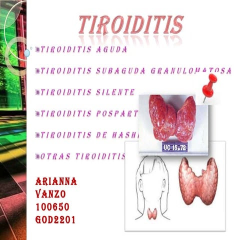 tiroiditis-130509160246-phpapp01.pdf