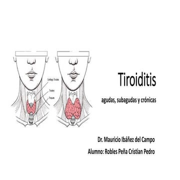 TIROIDITIS concepto fisiopatología diagnóstico tratamiento | PPTX