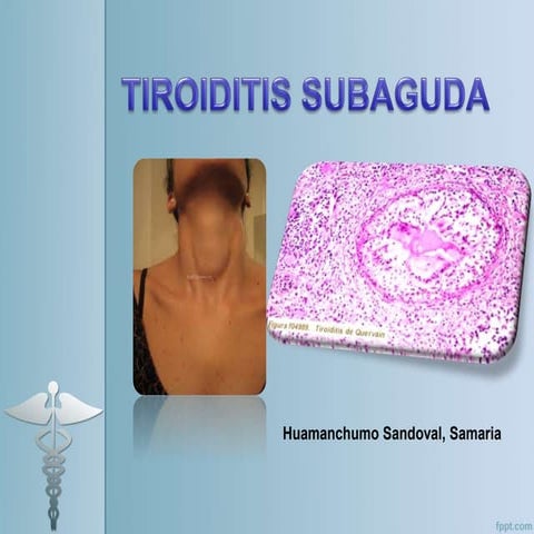 Tiroiditis subaguda - Samaria Huamanchumo Sandoval | PPTX