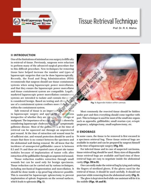 Hydrocelectomy | PPTX
