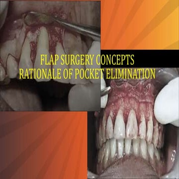 periodontal flap surgeries | PPTX
