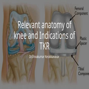 TKR for beginners total knee replacement.pptx