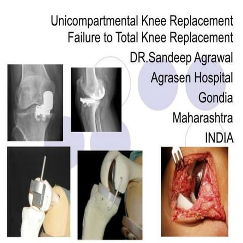 TKR For Failed Uniknee Replacement Surgery Dr Sandeep Agrawal Agrasen ...