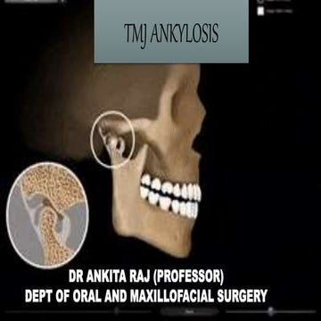 Tmj ankylosis | PPT
