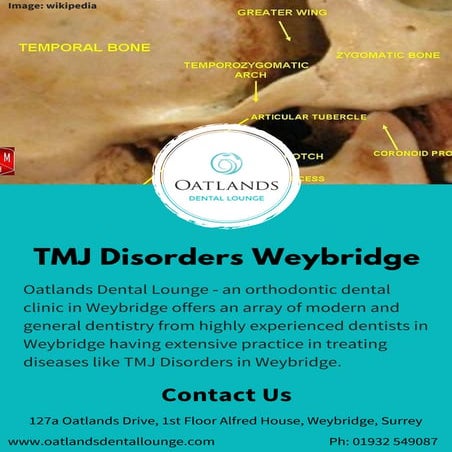 TMJ Disorders Weybridge | PDF