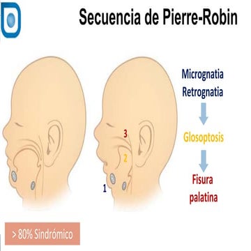 Secuencia de Pierre Robin