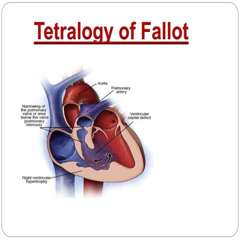 Tetralogy of Fallot : Dr. Akif Baig | PPTX