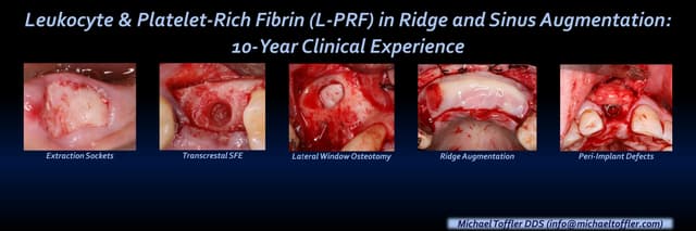 platelet rich plasma | PPTX