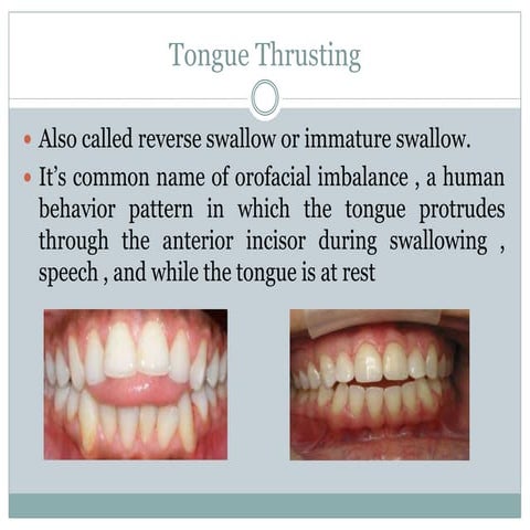 tongue-thrusting | PPT
