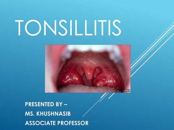 Tonsilitis | PPTX | Ear, Nose and Throat Conditions | Diseases and ...