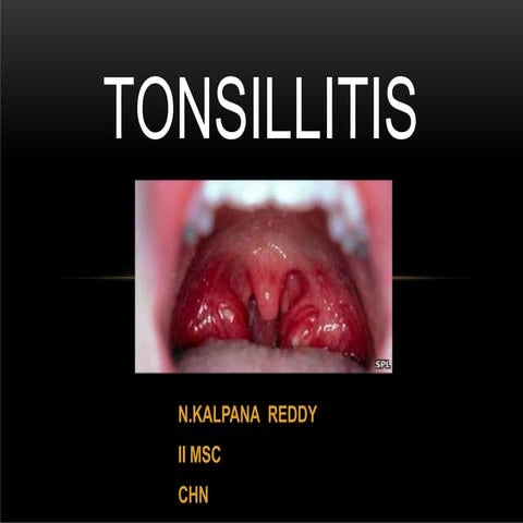 Tonsilitis ppt 1