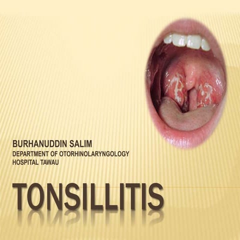 Tonsilitis | PPTX