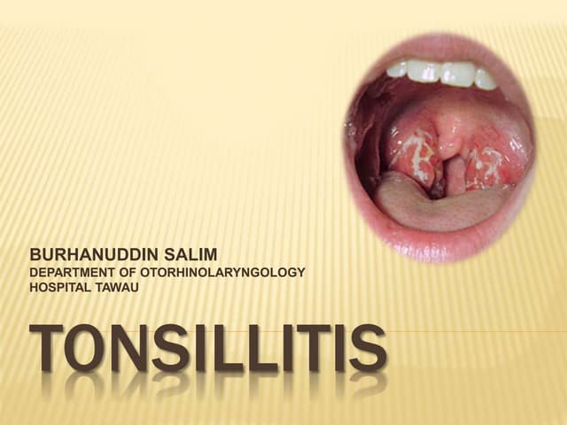 Pharyngitis Ppt