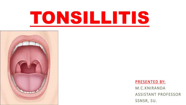 Tonsilitis ppt 1 | PPTX