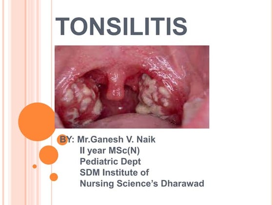 TONSILLITIS | PPTX | Ear, Nose and Throat Conditions | Diseases and Conditions