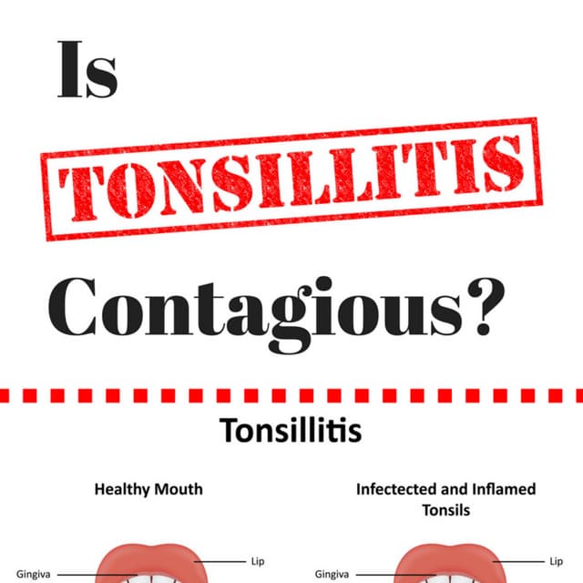 Is Tonsillitis Contagious? | PDF