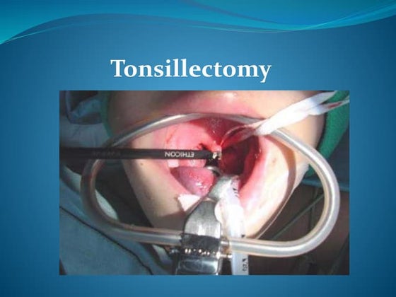 Tonsillectomy | PPT