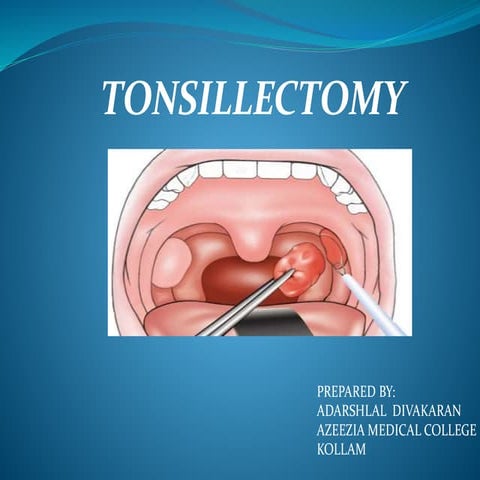 tonsillectomy ad ars h-161021153651.pdf