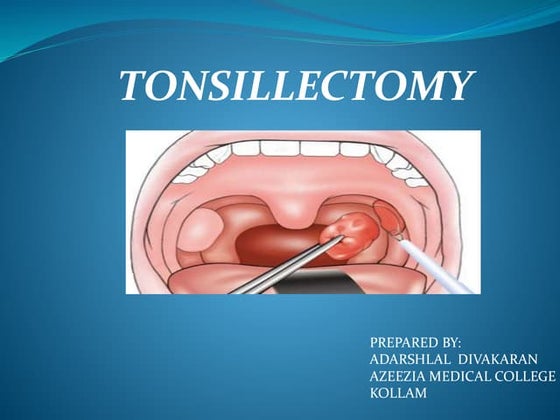 Tonsillectomy | PPT