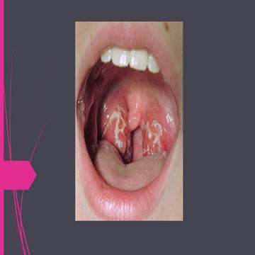 Tonsillitis Pptx Tonsillitis Pptx Presentation Pptx