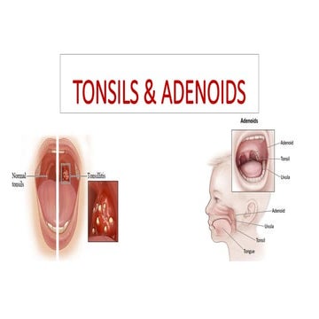 Tonsillitis new.pptx adenoids - ENT , adenoids hypertrophy and ...