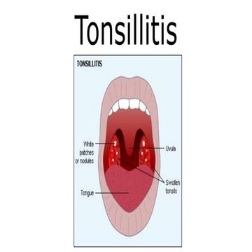 Tonsillitis, quinsy and adenoiditis | PPTX