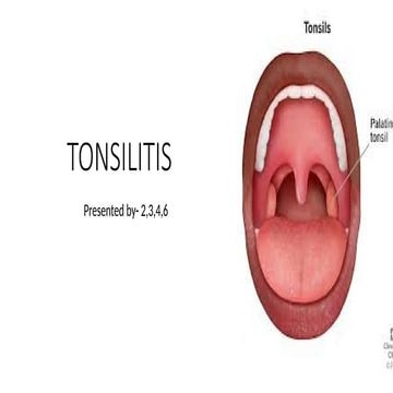 TONSIL infection of the tonsil it may be acute and chronic | PPT