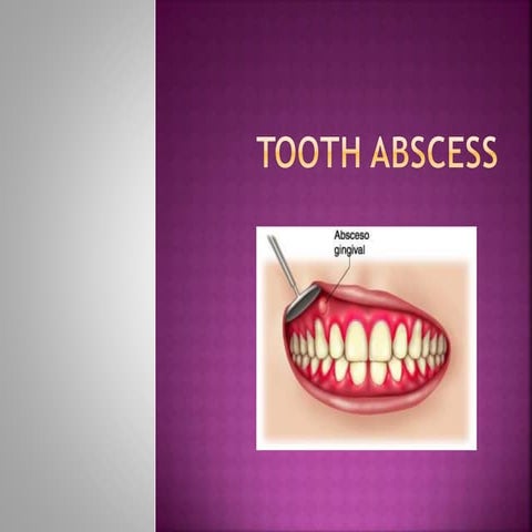 Tooth abscess | PPTX