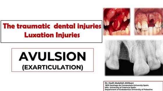The avulsed tooth | PPT