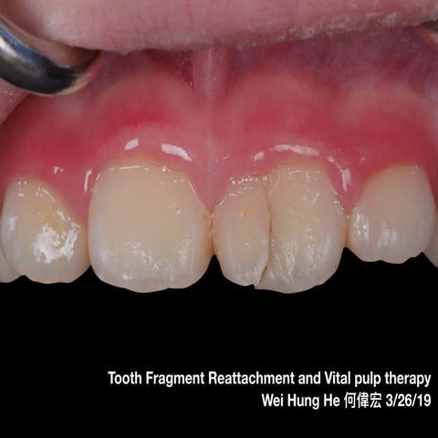 Tooth fragment reattachment and vital pulp therapy | PDF