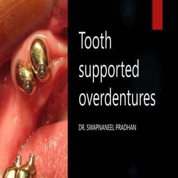 Tooth-supported overdentures guide | PPT