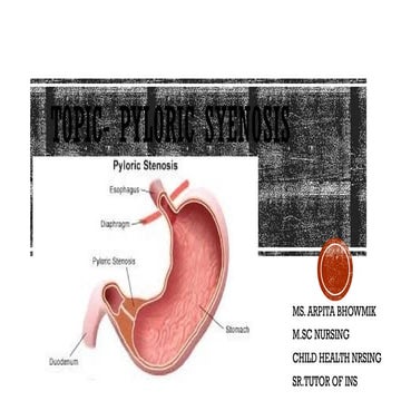 TOPIC- PYLORIC SYENOSIS. disease in gastrointestinal disoder | PPTX