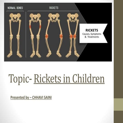 Topic- Rickets in children by Chhavi Saini | PPTX
