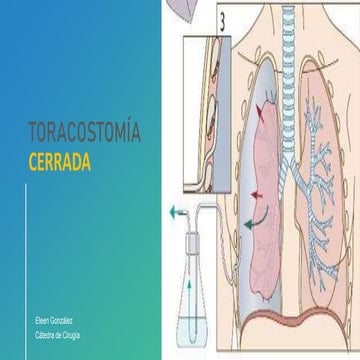 Toracostomía Cerrada/Eleen González 2023 | PPTX