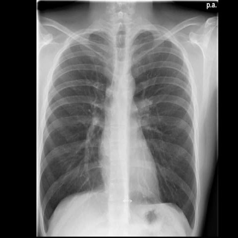 Torax pa normal v | PPS