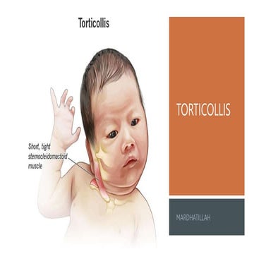 TORTICOLLIS | PPT
