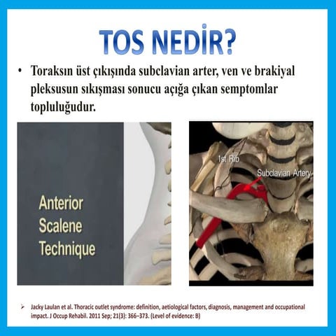 Torasik Outlet Sendromu | PPTX
