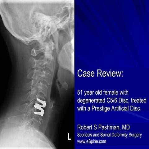 Case Review #7: 51 year old female with Prestige Cervical Disc ...