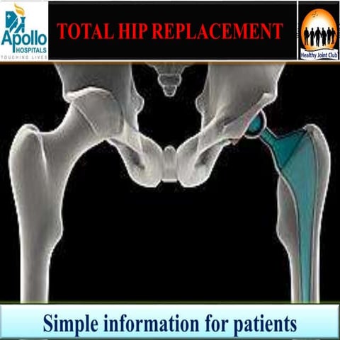 Total hip replacement | PPTX