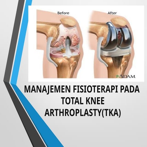 Panatalaksanaan Fisioterapi pada kasus Total Knee Replacement.pptx