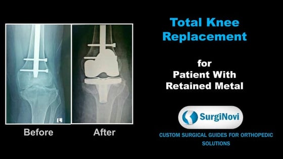 Total knee replacement for 120 cm dwarf using custom made surgical ...