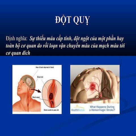 độT quỵ | PPT