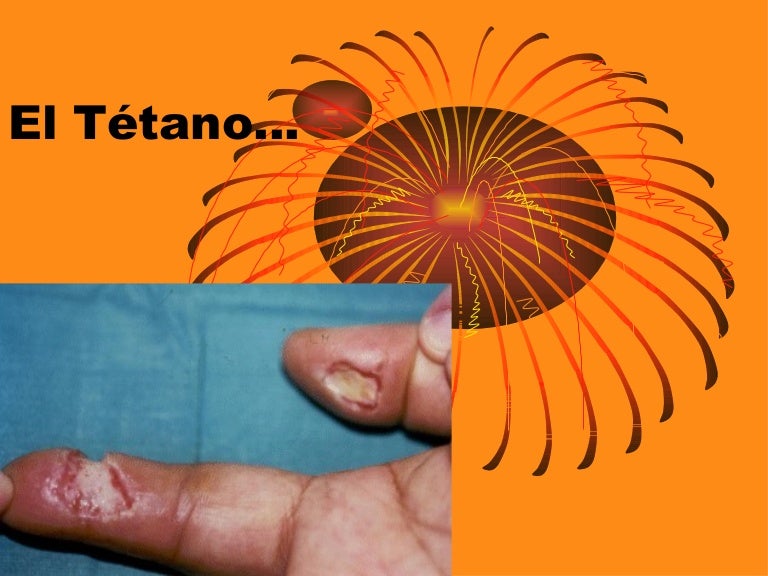 Trabajo de investigación sobre Tétanos realizado por Iván Burgos y Os…