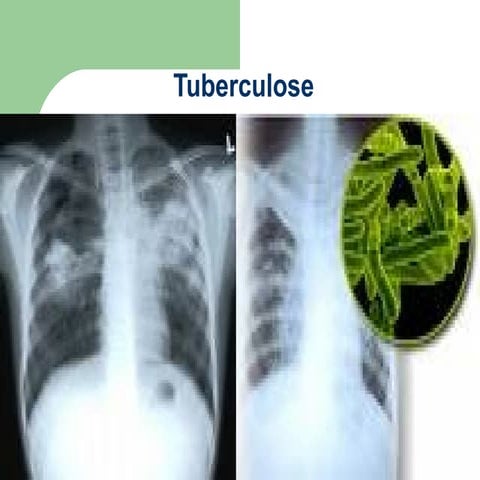 Trab Pronto D Tuberculose | PPT